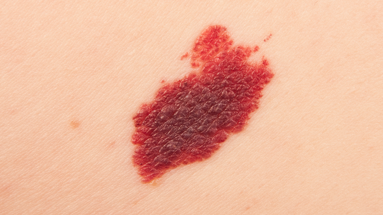 ¿Cuándo un lunar es cancerígeno? Descubre 5 signos del Cáncer de Piel