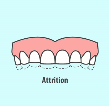 Golden State Dentistry | Blog | dental attrition