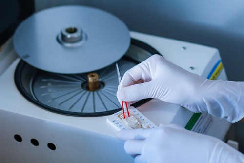 overcoming hematocrit accuracy issues: VAMS vs. DBS