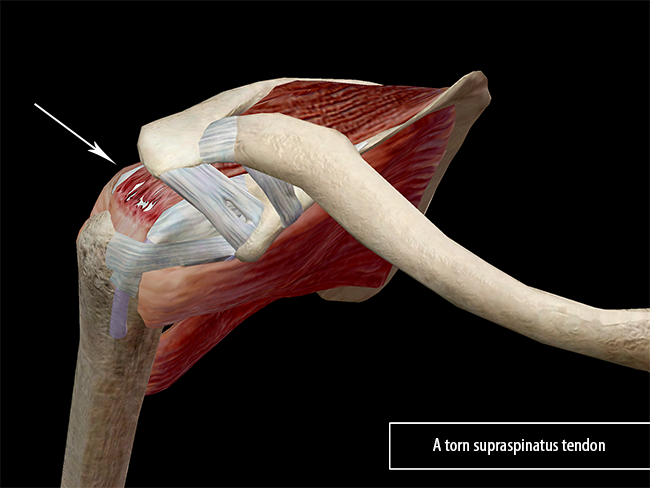 Learn Muscle Anatomy: Of Dads and Rotator Cuff Injuries