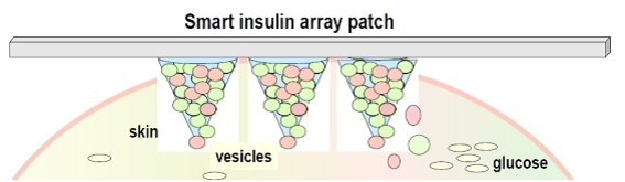 Smart Insulin Patches or Glucose-Responsive Insulin Delivery Systems