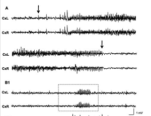 Narcolepsy Brain Waves