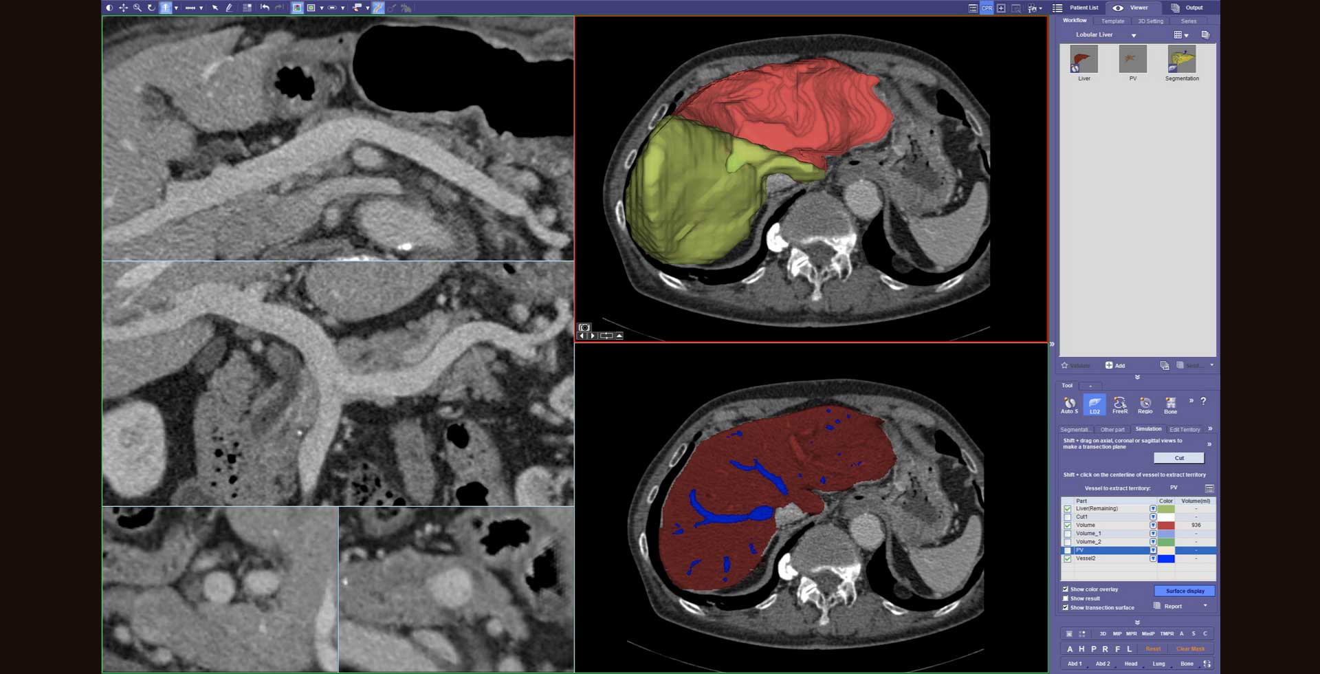 Liver Segmentation Advanced Visualization Package | Terarecon Liver Segmentation Advanced Visualization Package | Terarecon
