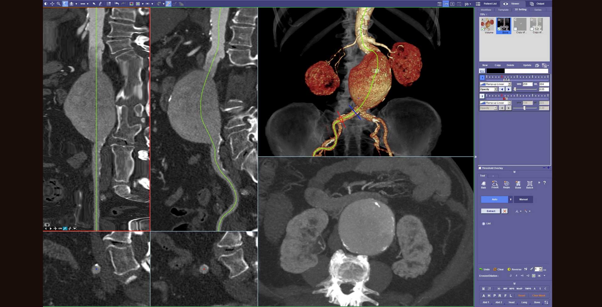 EVAR Planning Clinical Package | Terarecon
