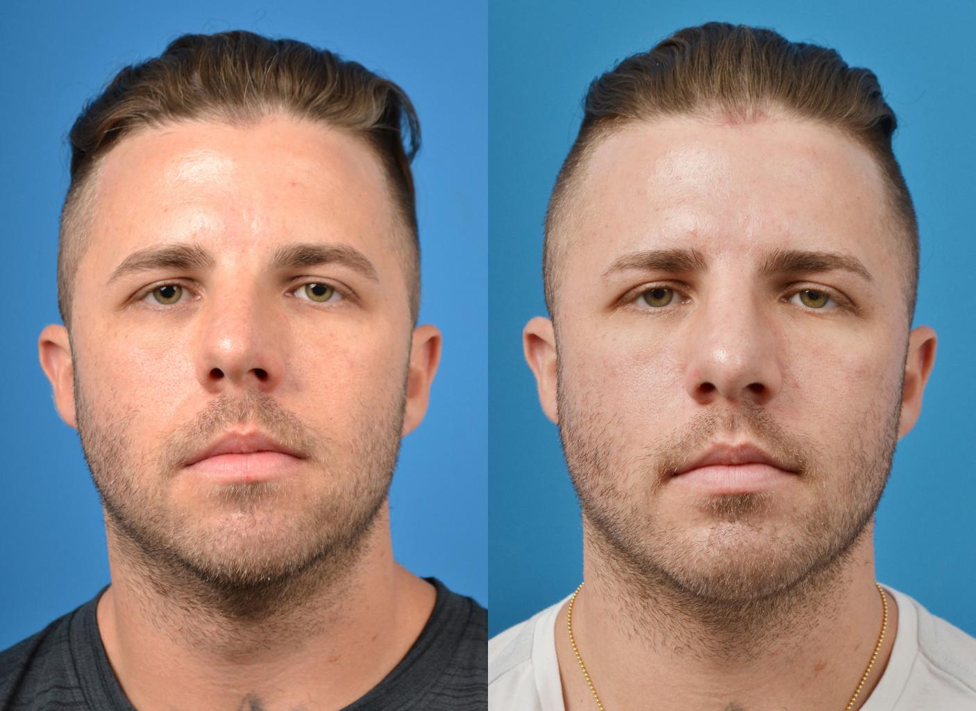 Chin Augmentation Photos | Melbourne, FL | Patient 26772