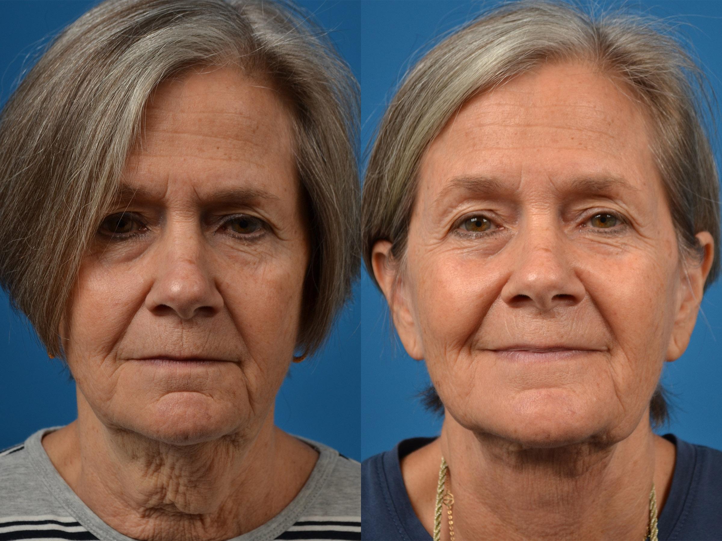 Profile Neck Lift Photos | Melbourne, FL | Patient 52530