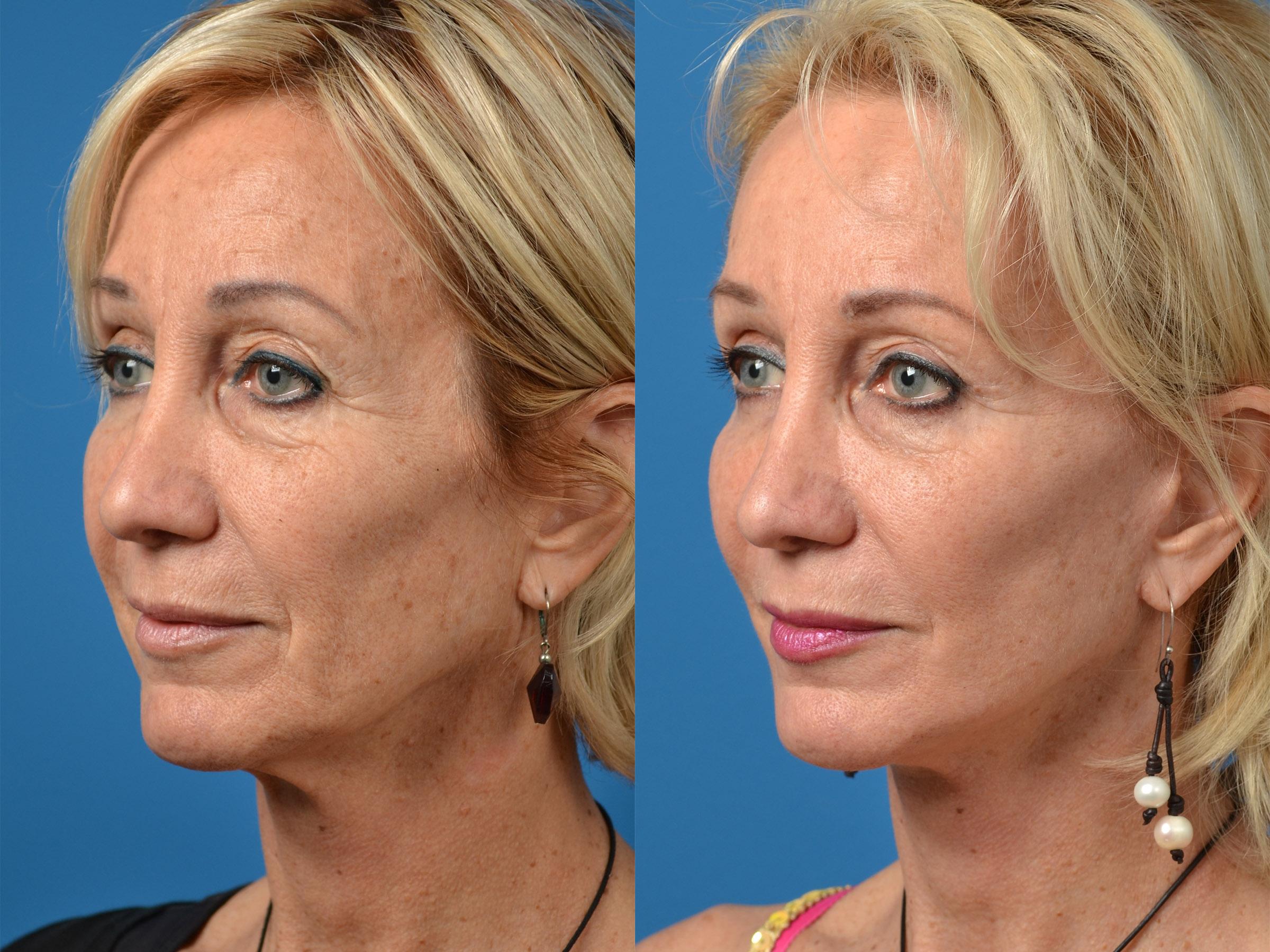Facelift Photos | Melbourne, FL | Patient 52551