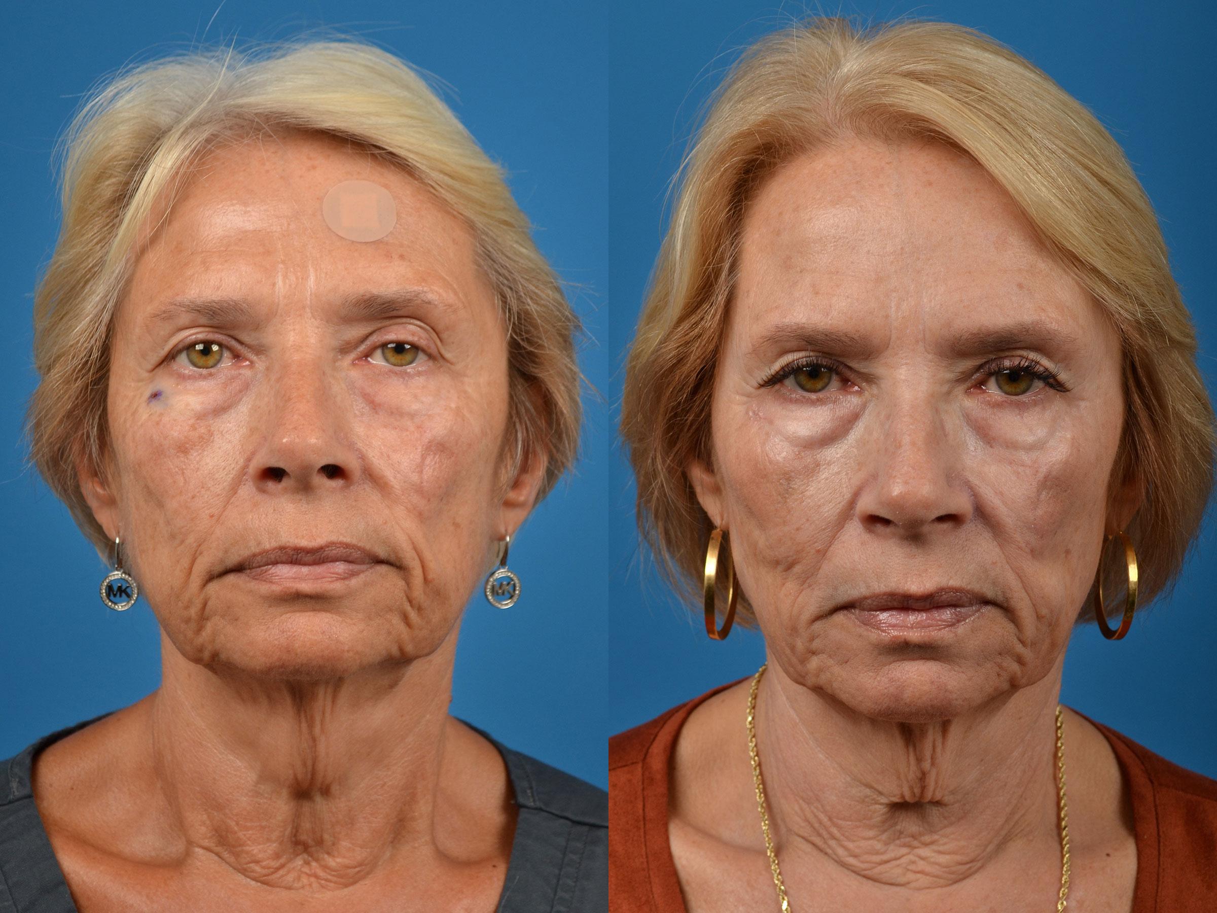 Mohs Surgery and Skin Cancer Photos | Melbourne, FL | Patient 55412