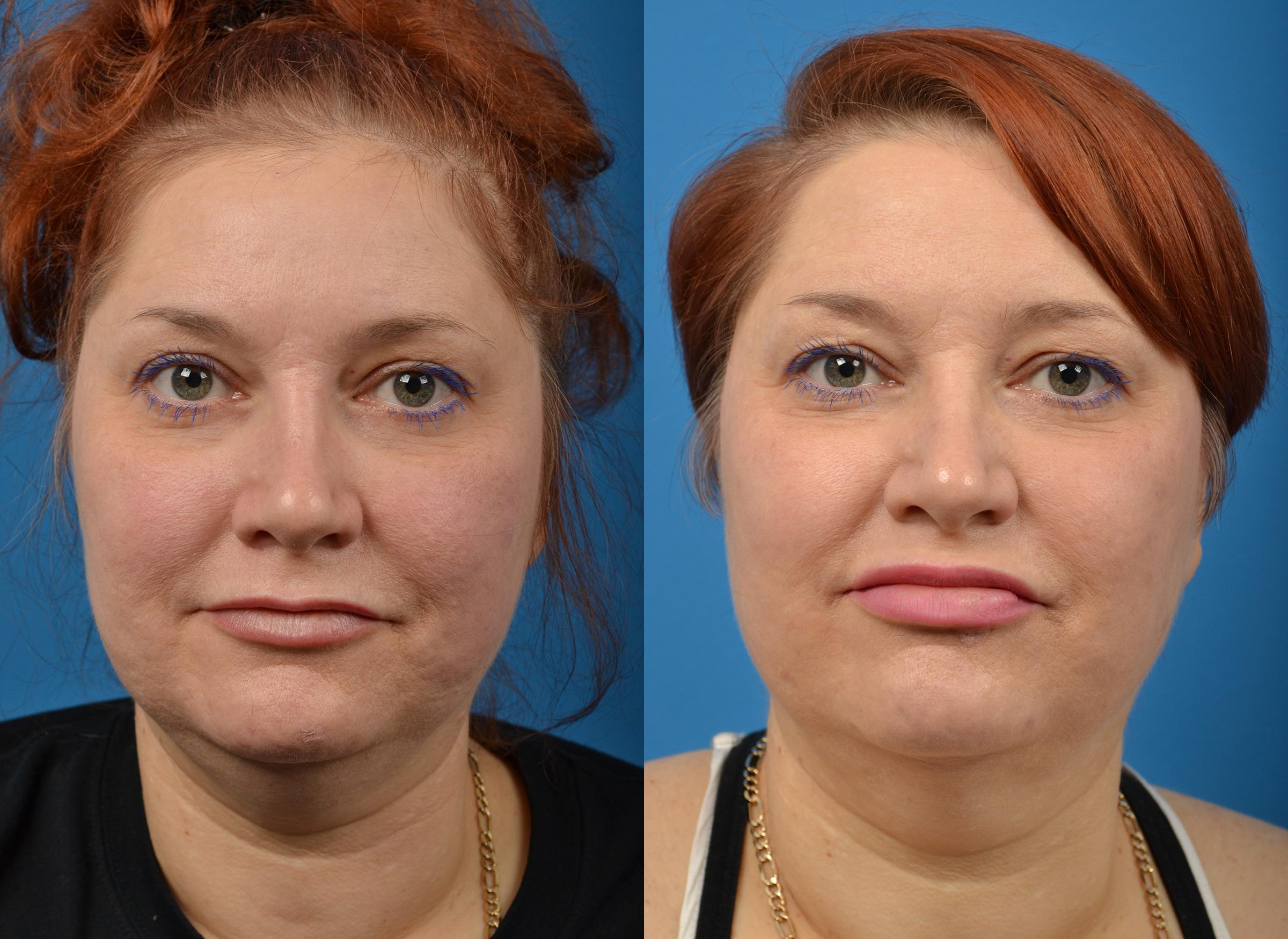 Kybella Photos | Melbourne, FL | Patient 58553
