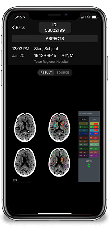 Neuroimaging Stroke Software Platform Powered by AI | RapidAI